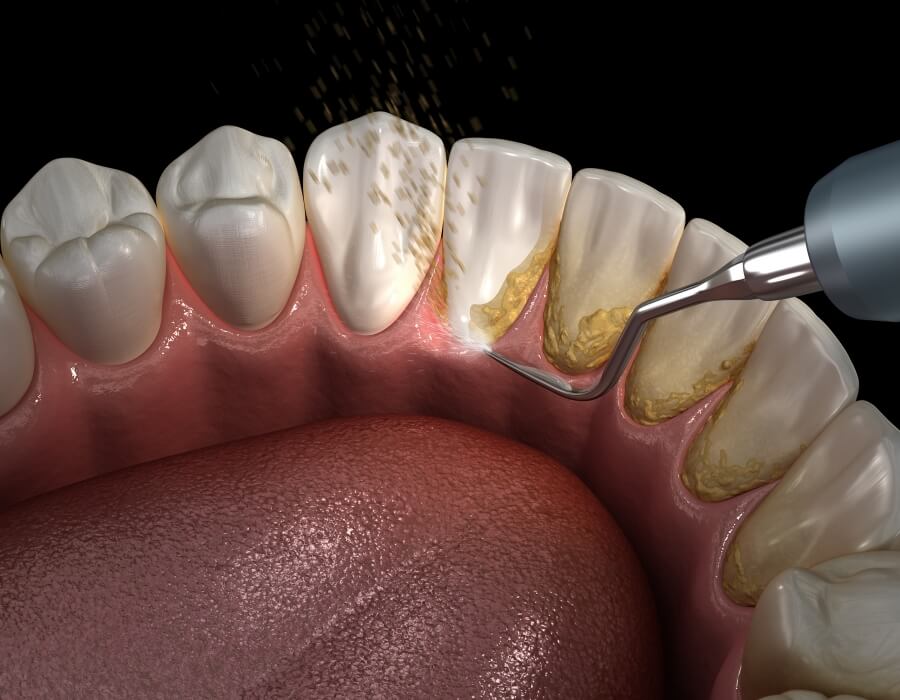 All That You Must Know About Stain Removal Treatment For Teeth ...