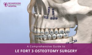 A Comprehensive Guide To Le Fort 3 Osteotomy Surgery – Richardson's ...