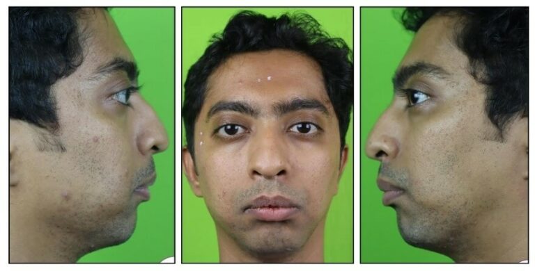 Facial Profile Transformative Journey of Our Patient – Richardson's ...