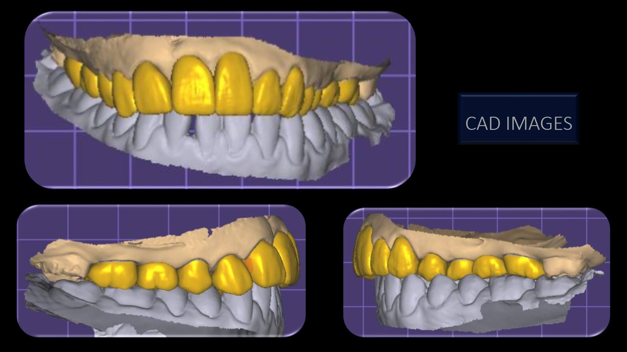 Prosthetic Rehabilitation Post Anterior Maxillary Distraction ...