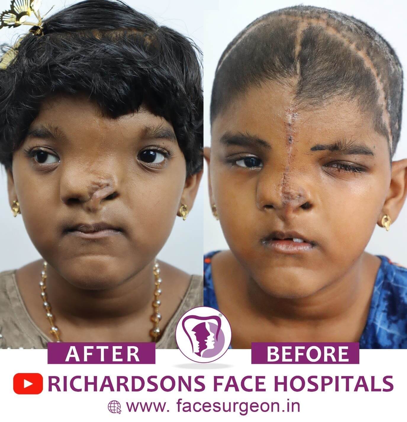 Case Study Of A Rare Case With Tessier Cleft, Hypertelorism And Bifid ...
