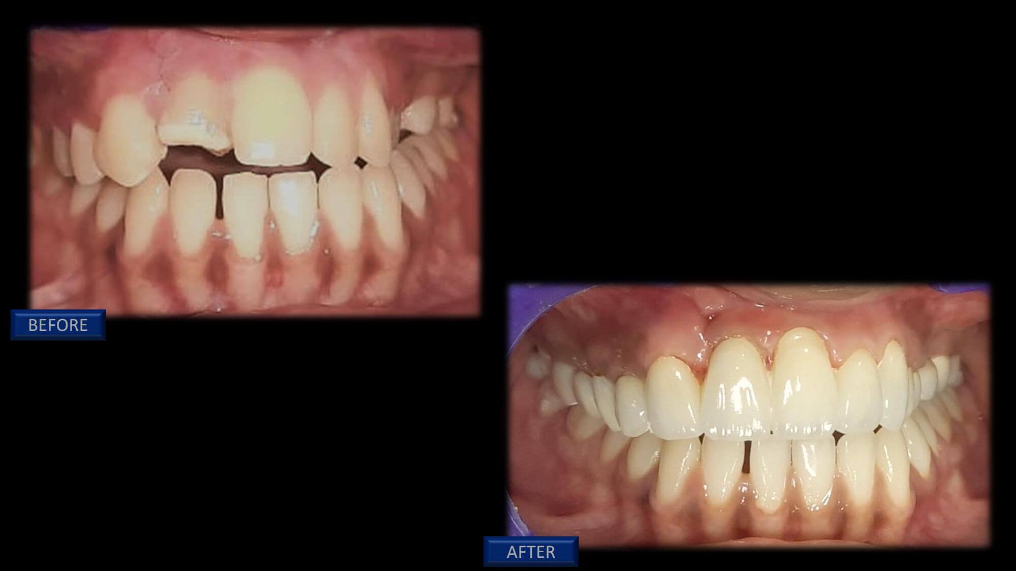 Prosthetic Rehabilitation Post Anterior Maxillary Distraction ...