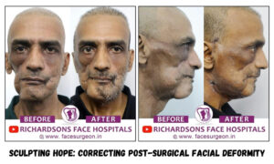 Facial Restoration Triumph | Correcting Post-Cancer Deformity ...