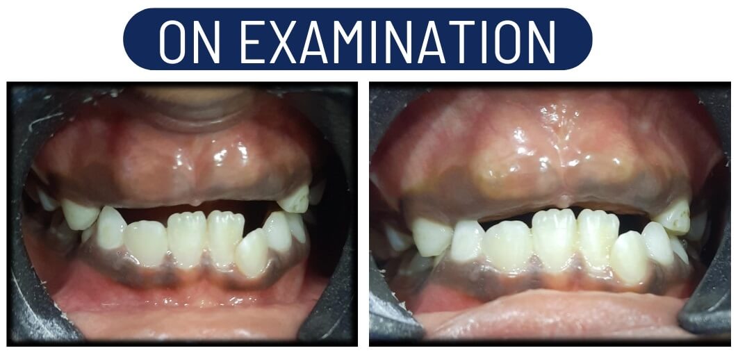 Delayed Eruption Of Permanent Incisors After Operculectomy – Richardson ...