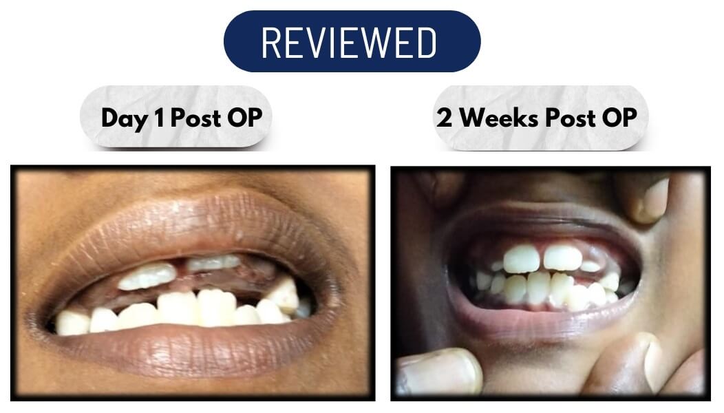 Delayed Eruption Of Permanent Incisors After Operculectomy – Richardson ...