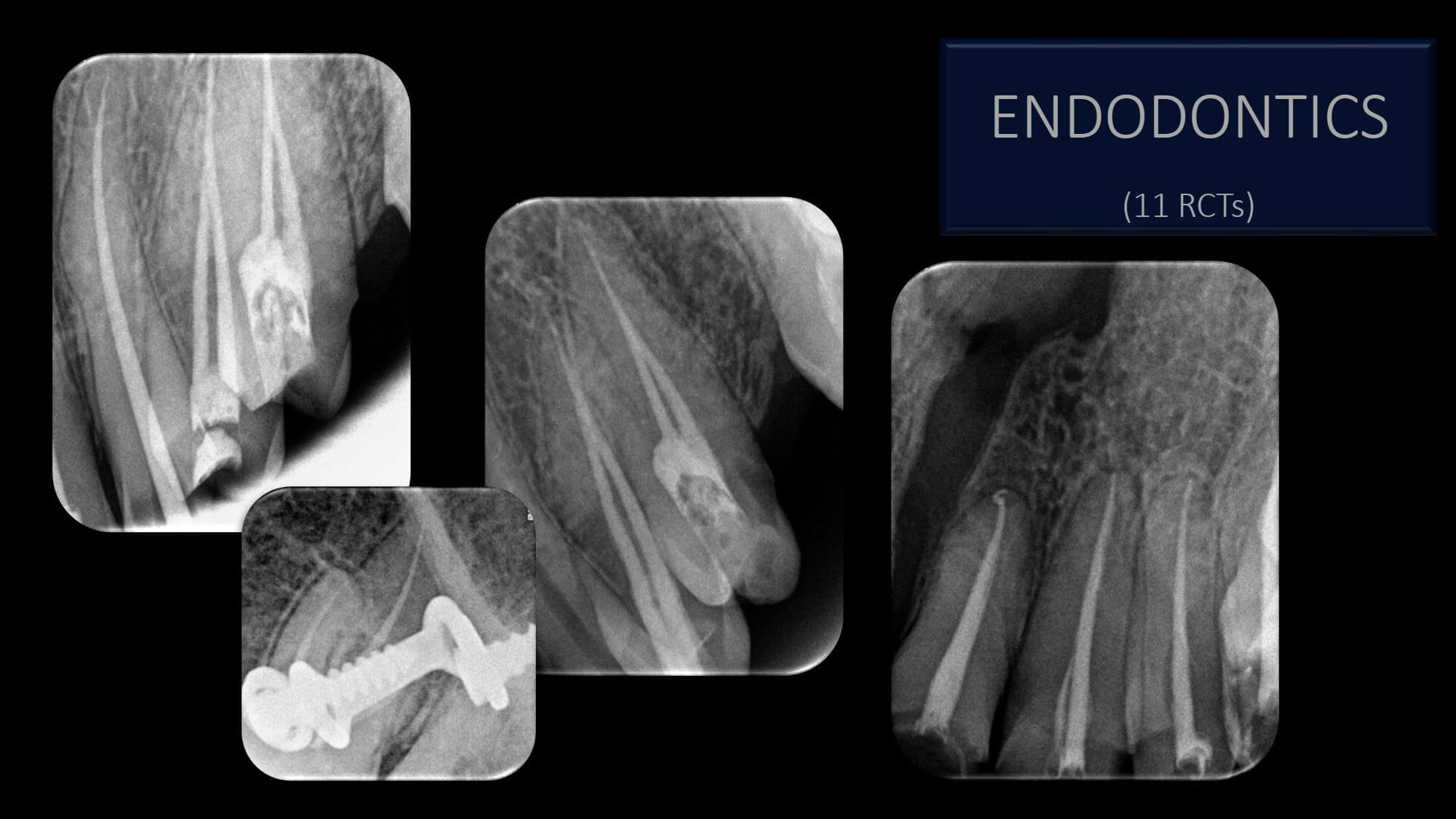 Prosthetic Rehabilitation Post Anterior Maxillary Distraction ...