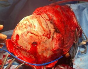 Case Study Of A Rare Case With Tessier Cleft, Hypertelorism And Bifid ...