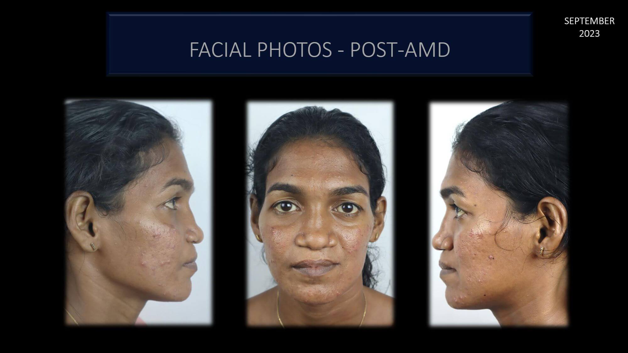 Prosthetic Rehabilitation Post Anterior Maxillary Distraction ...