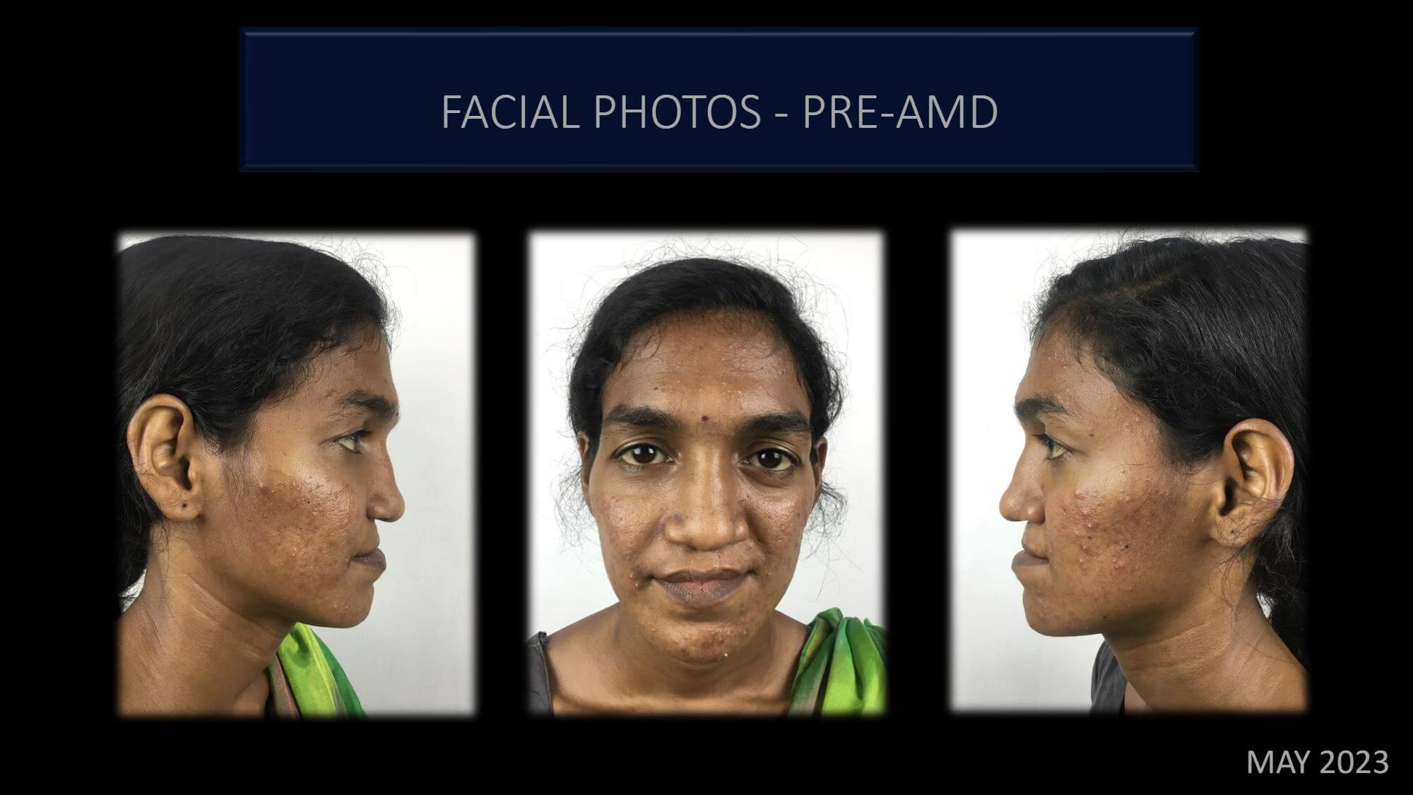 Prosthetic Rehabilitation Post Anterior Maxillary Distraction ...