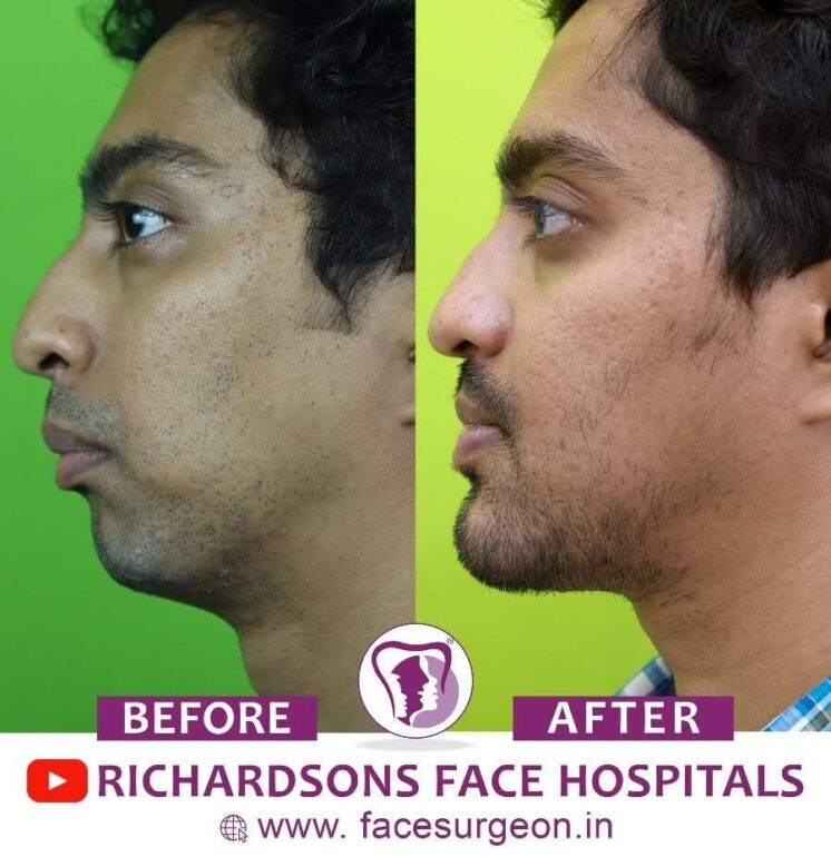 Facial Profile Transformative Journey Of Our Patient – Richardson's ...