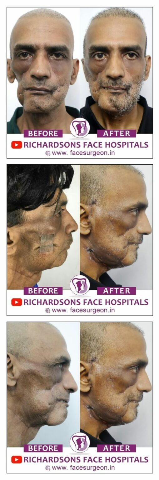 Facial Restoration Triumph | Correcting Post-Cancer Deformity ...