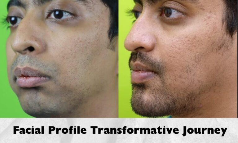 Facial Profile Transformative Journey Of Our Patient – Richardson's ...