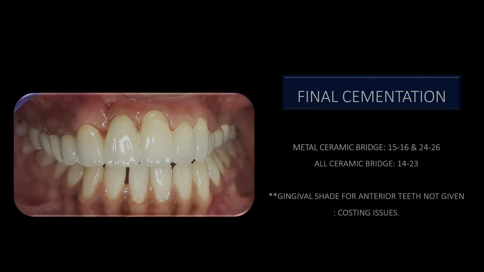 Prosthetic Rehabilitation Post Anterior Maxillary Distraction ...