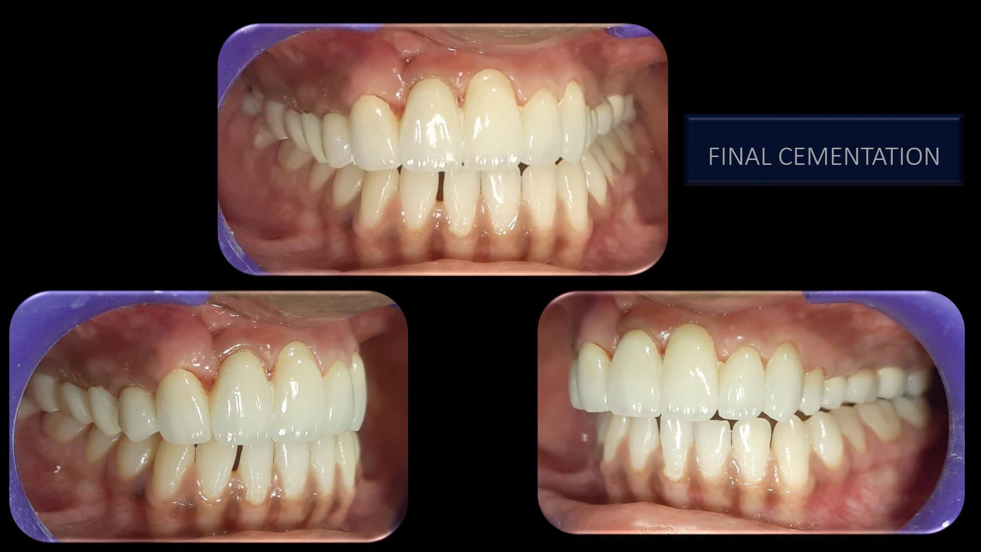 Prosthetic Rehabilitation Post Anterior Maxillary Distraction ...
