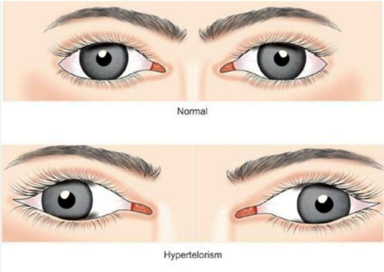 Case Study Of A Rare Case With Tessier Cleft, Hypertelorism And Bifid ...