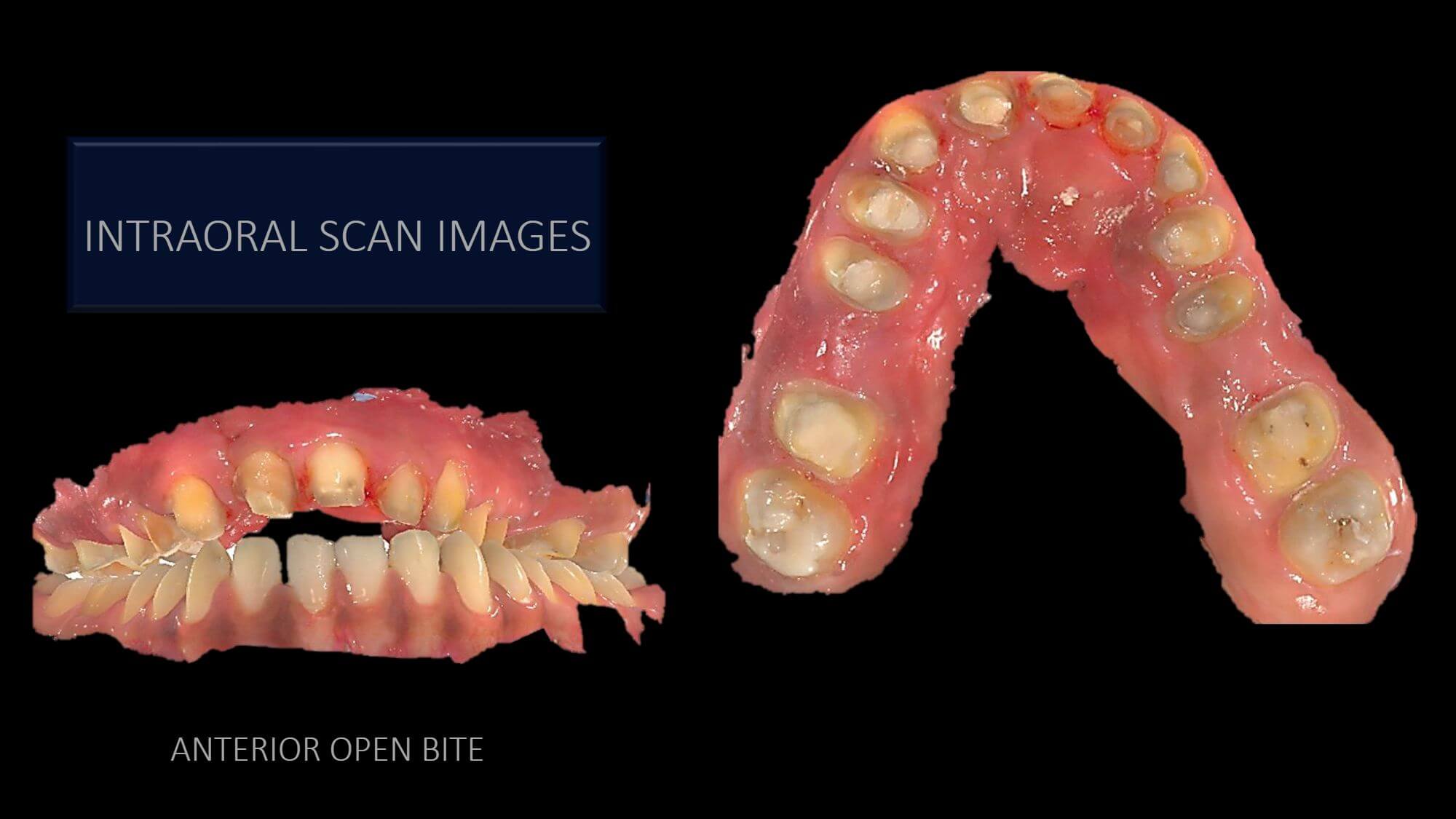 Prosthetic Rehabilitation Post Anterior Maxillary Distraction ...