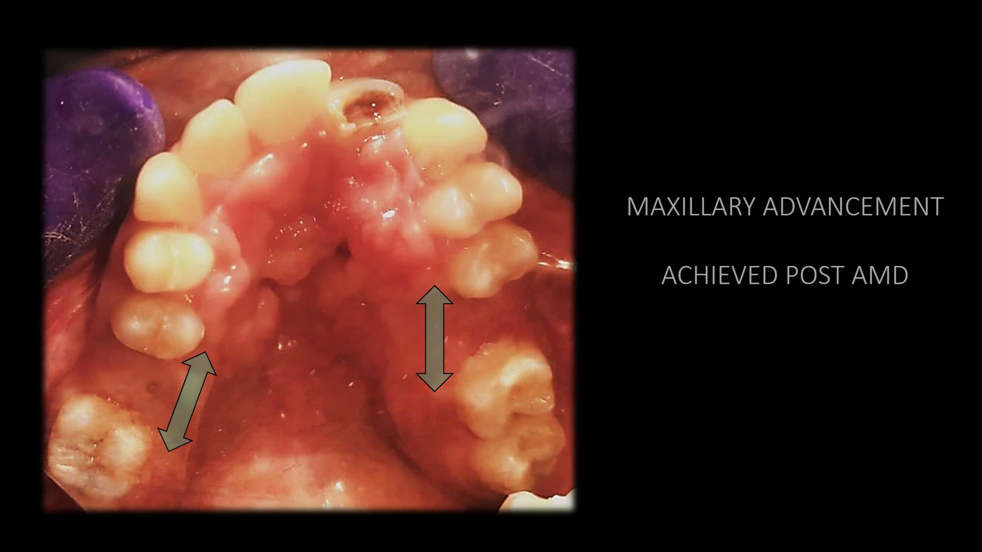 Prosthetic Rehabilitation Post Anterior Maxillary Distraction ...