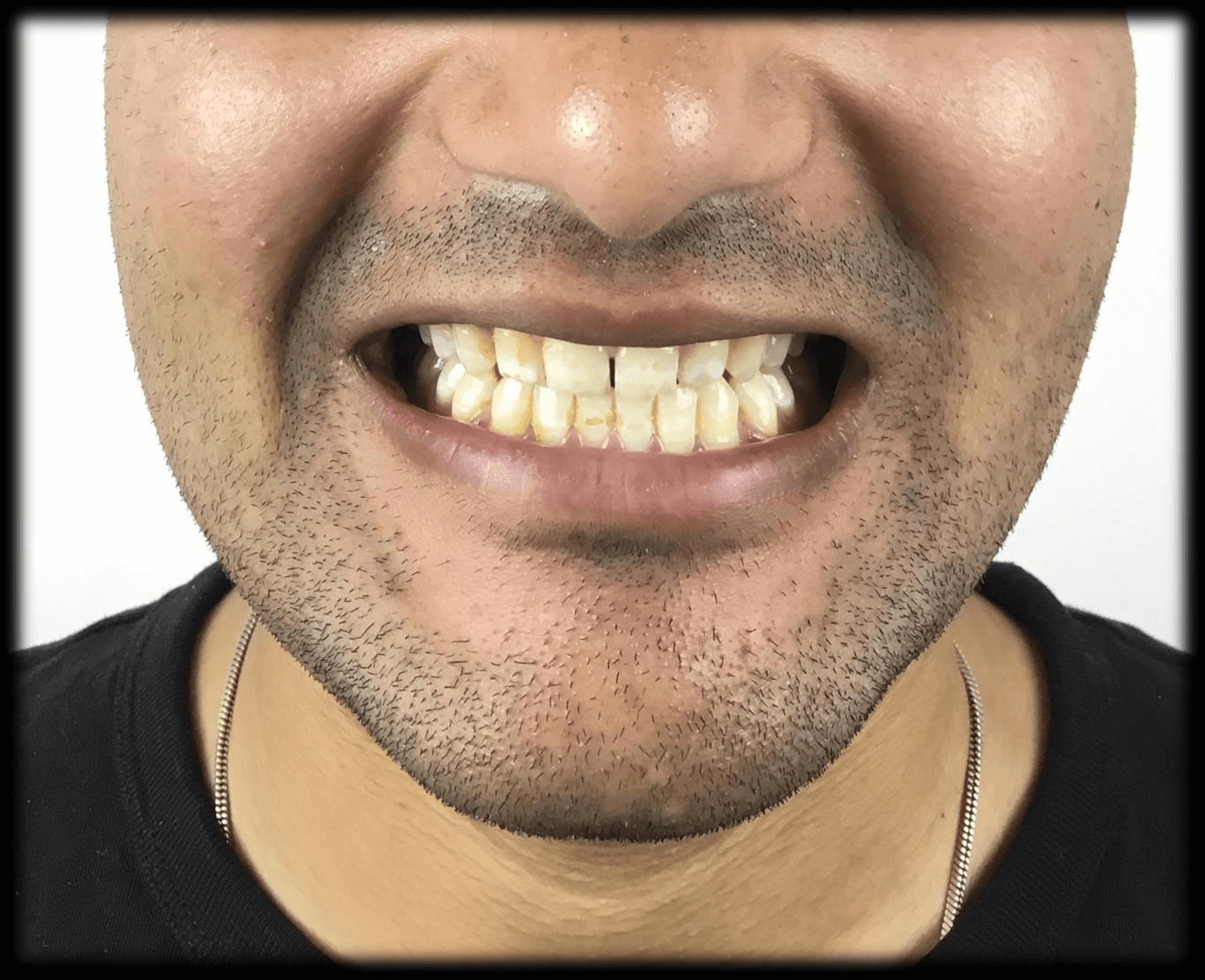 Smile Designing Mild Fluorosis | Mohit – Richardson's Plastic Surgery ...