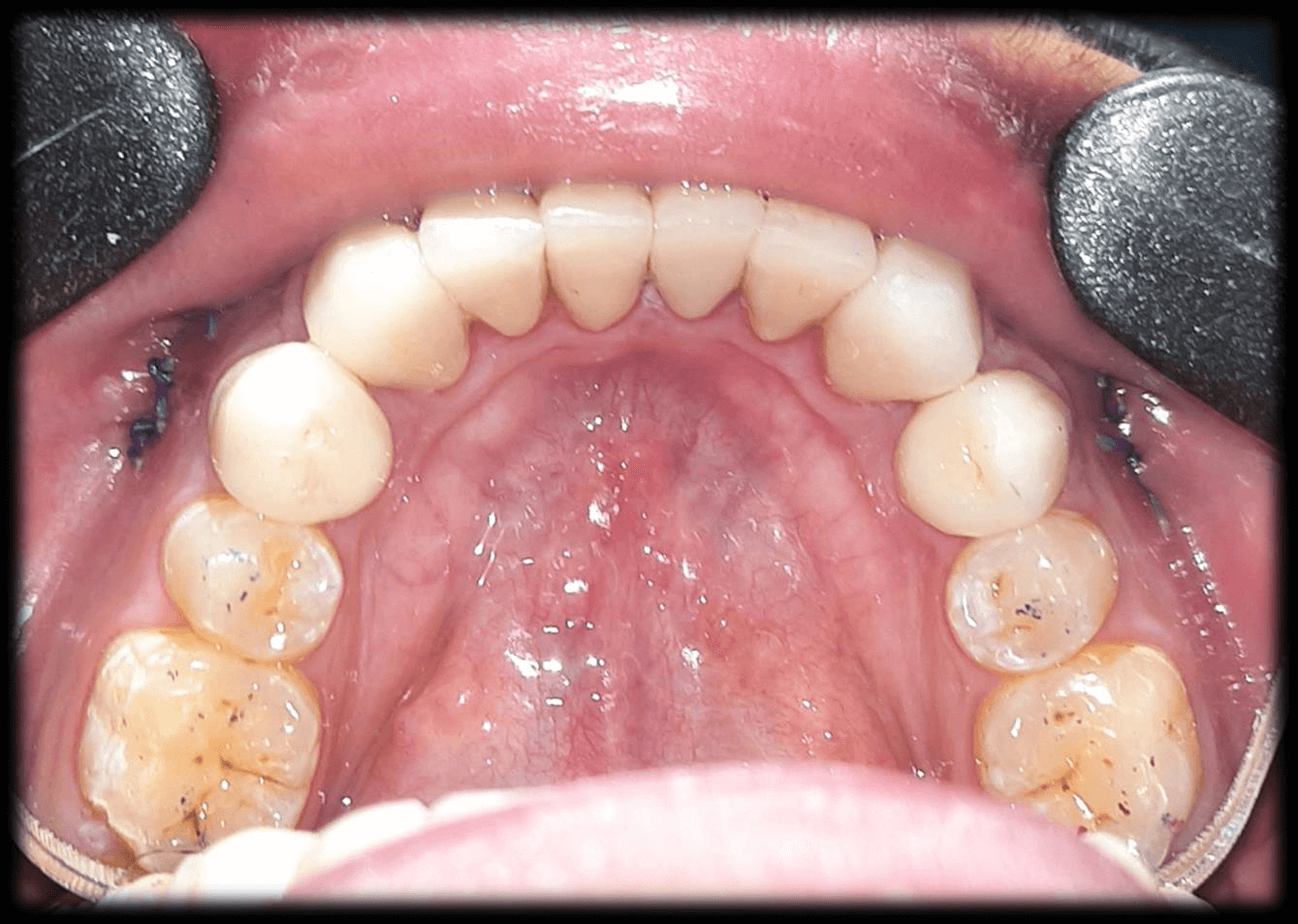 Smile Designing Mild Fluorosis | Mohit – Richardson's Plastic Surgery ...