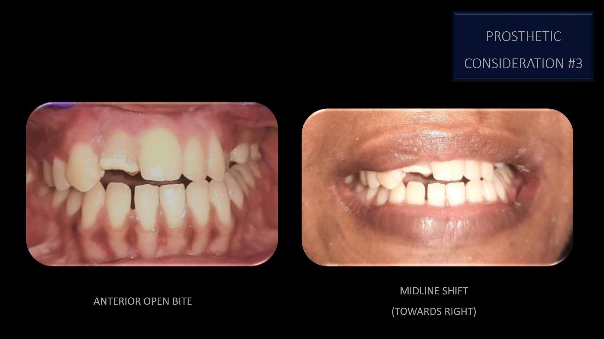 Prosthetic Rehabilitation Post Anterior Maxillary Distraction ...