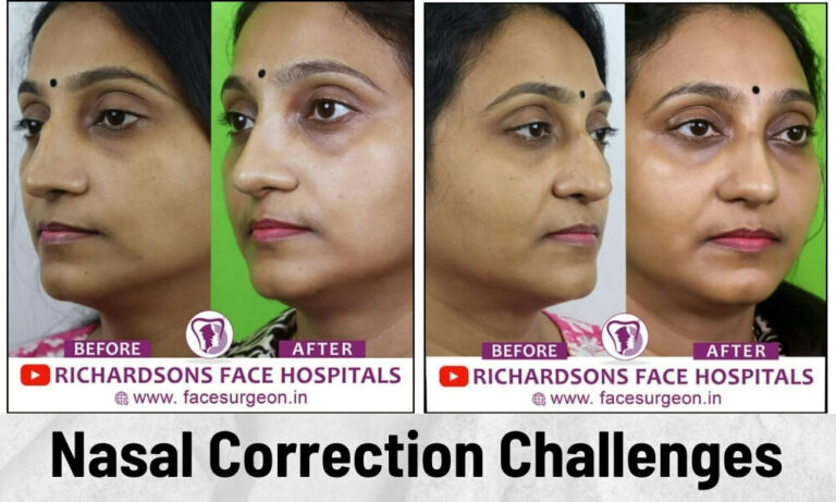 Nasal Transformation | Open Structure Rhinoplasty With Rib Cartilage ...