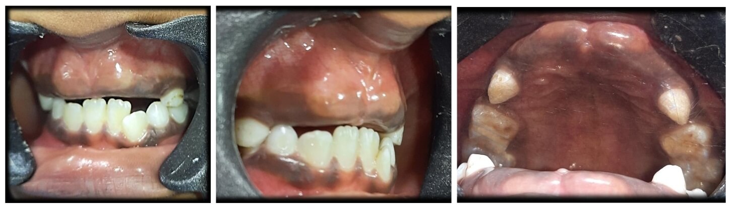 Delayed Eruption Of Permanent Incisors After Operculectomy – Richardson ...
