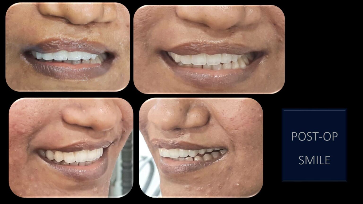 Prosthetic Rehabilitation Post Anterior Maxillary Distraction ...