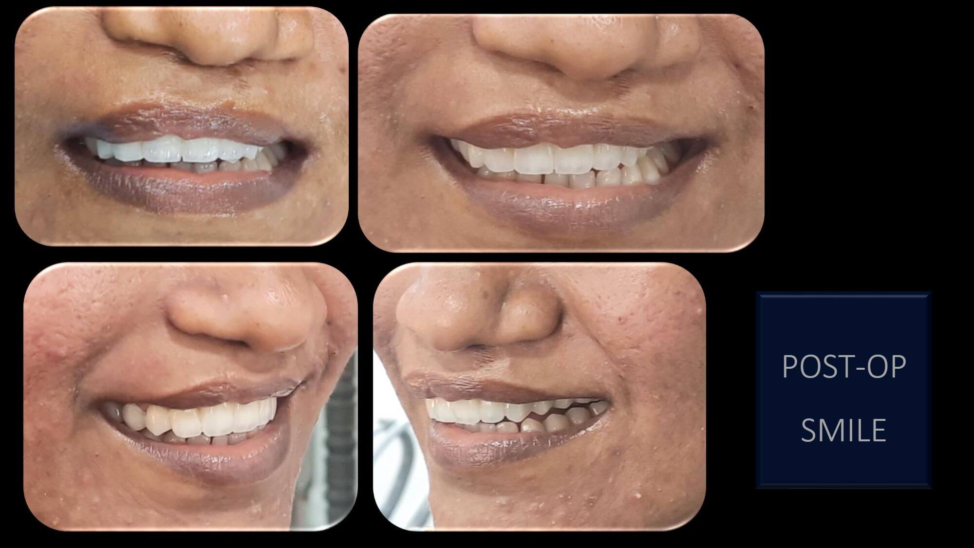 Prosthetic Rehabilitation Post Anterior Maxillary Distraction ...