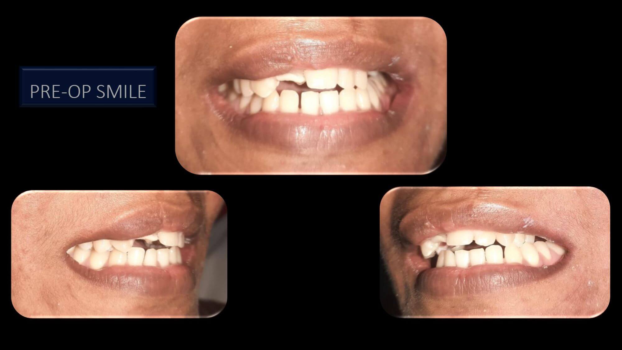 Prosthetic Rehabilitation Post Anterior Maxillary Distraction ...