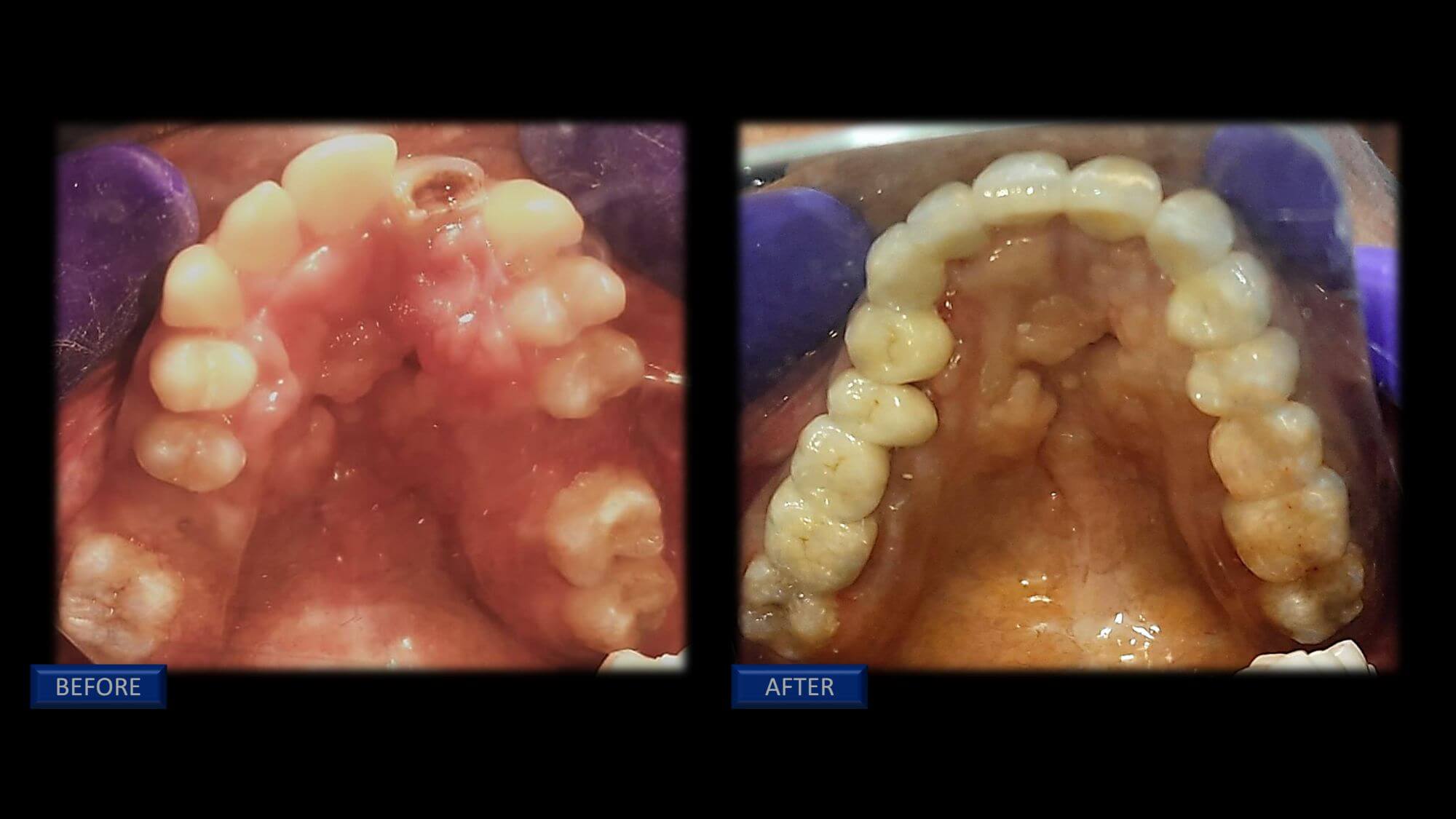 Prosthetic Rehabilitation Post Anterior Maxillary Distraction ...