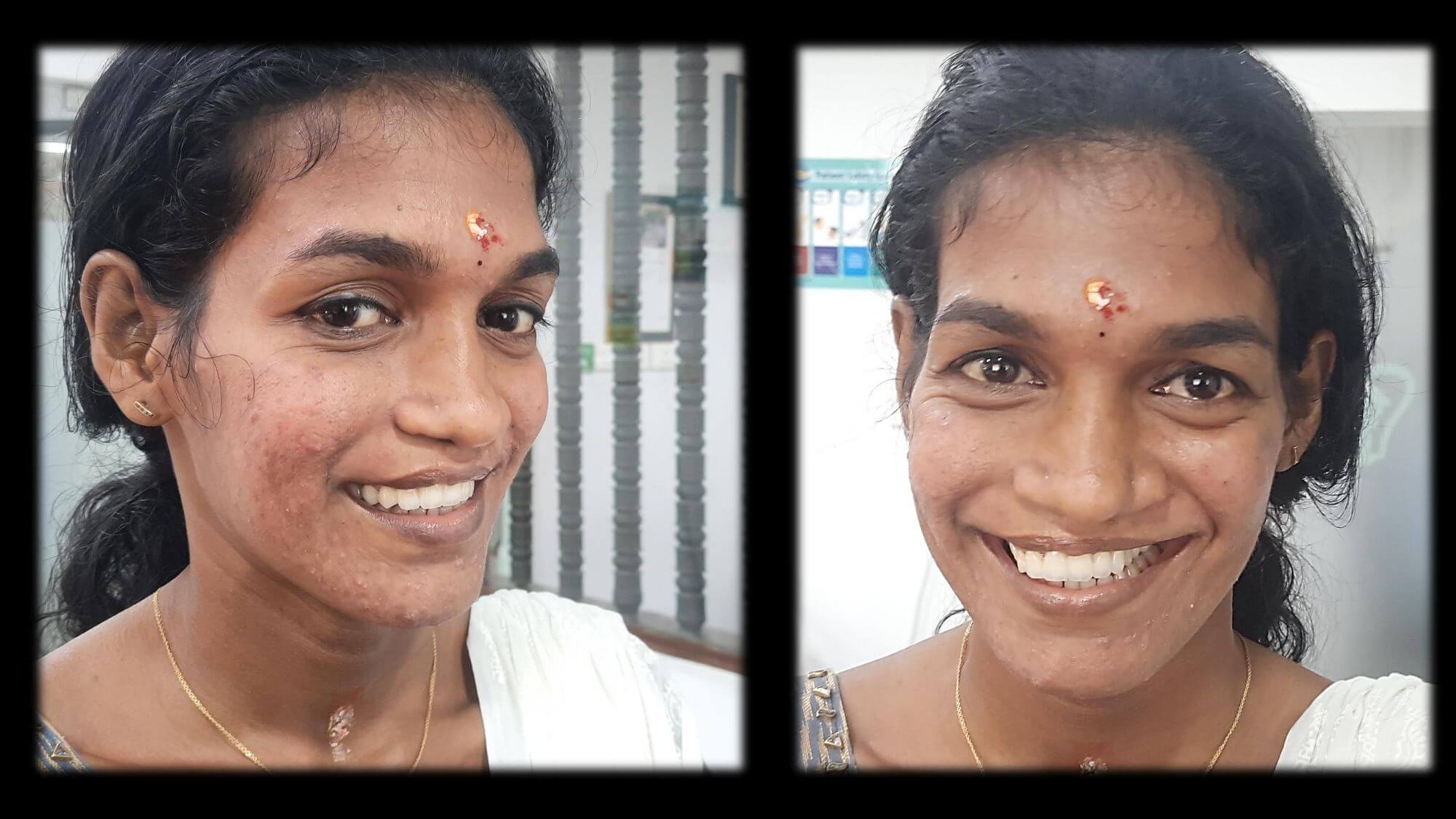 Prosthetic Rehabilitation Post Anterior Maxillary Distraction ...