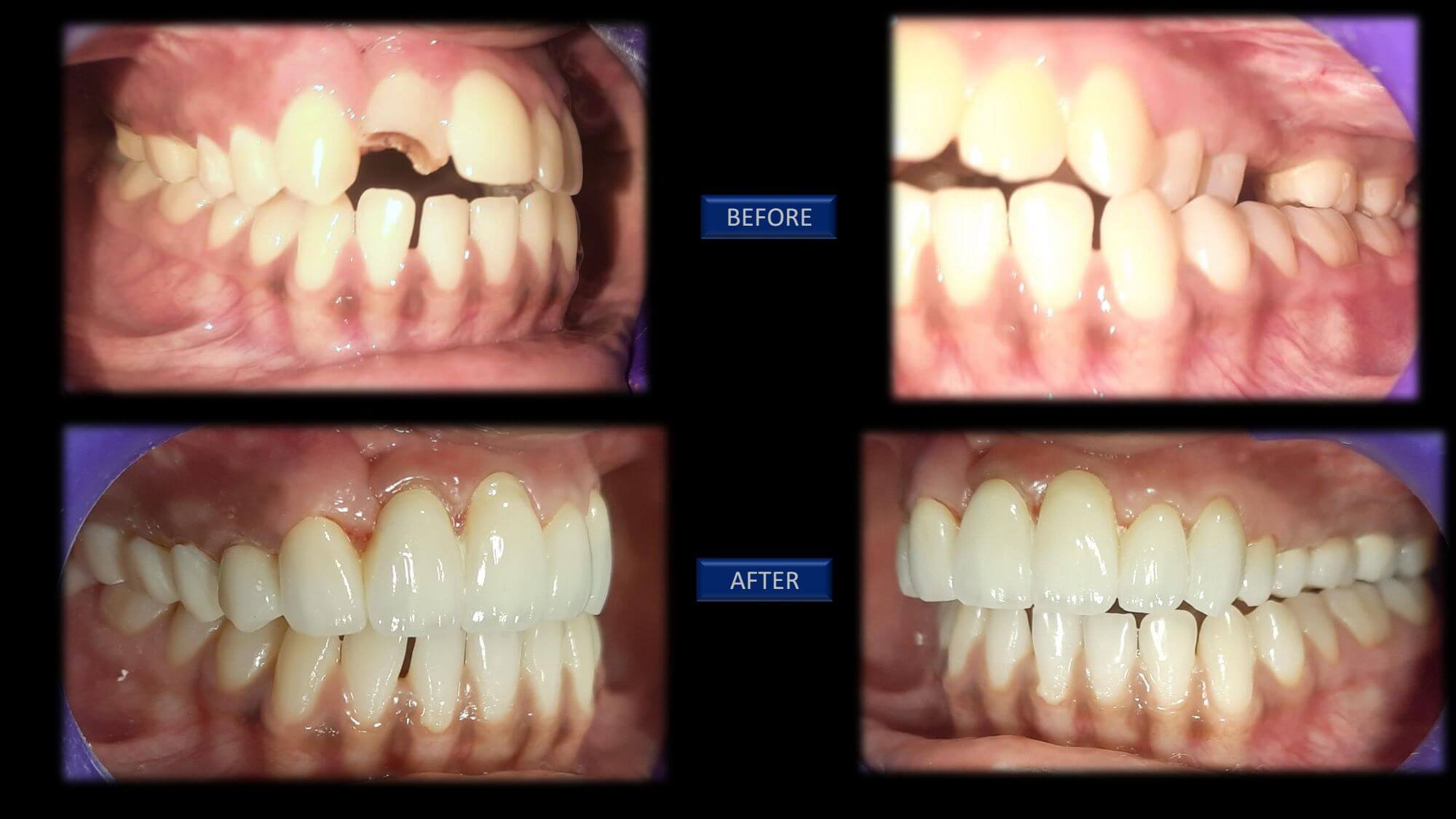 Prosthetic Rehabilitation Post Anterior Maxillary Distraction ...