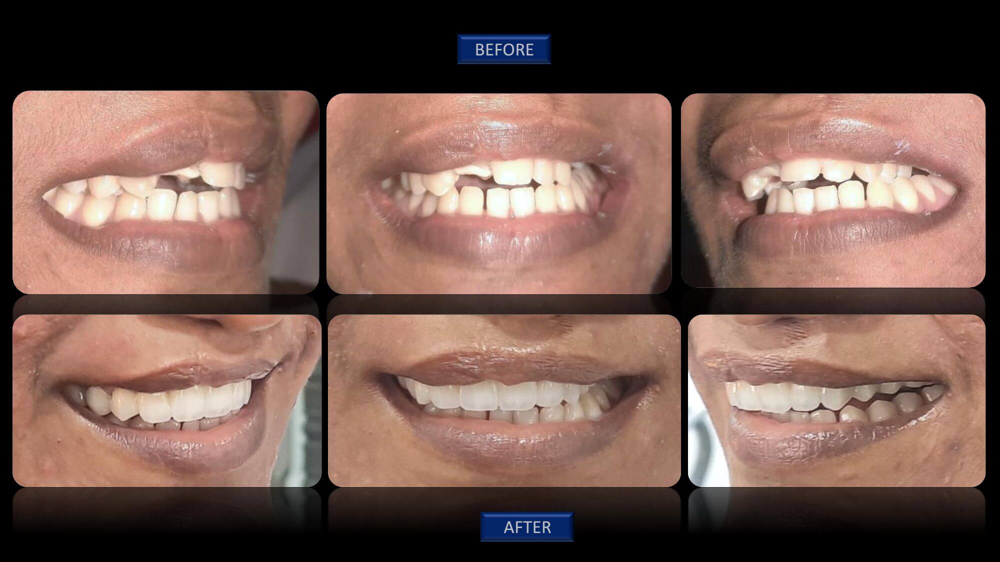 Prosthetic Rehabilitation Post Anterior Maxillary Distraction ...
