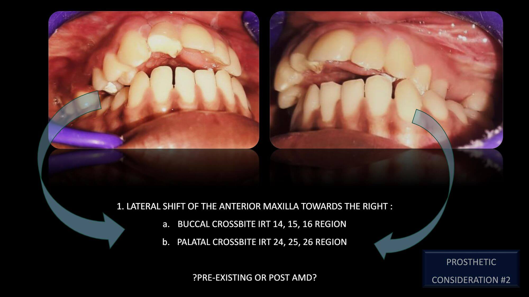 Prosthetic Rehabilitation Post Anterior Maxillary Distraction ...