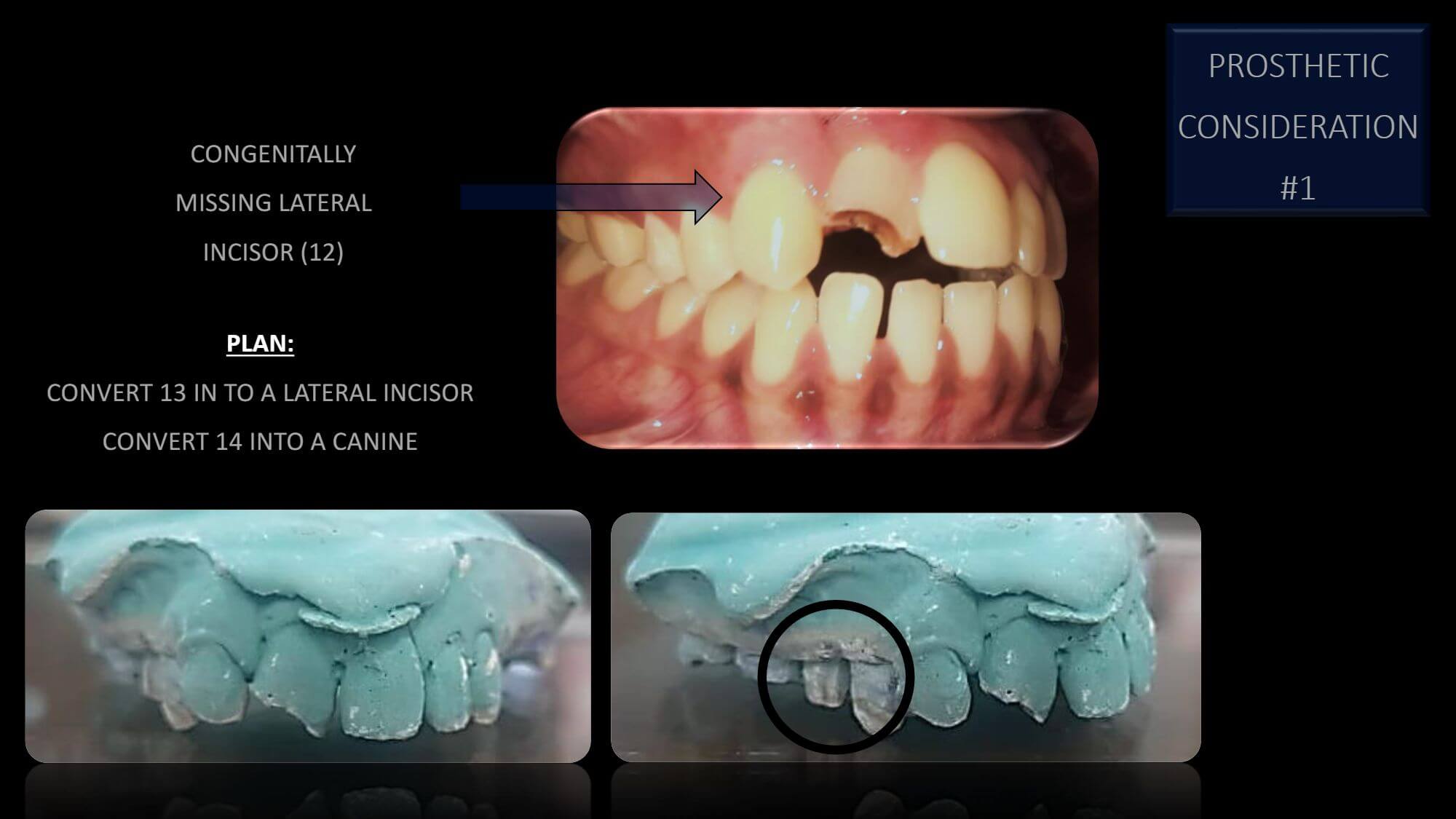 Prosthetic Rehabilitation Post Anterior Maxillary Distraction ...