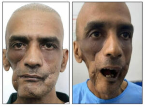 Facial Restoration Triumph | Correcting Post-Cancer Deformity ...