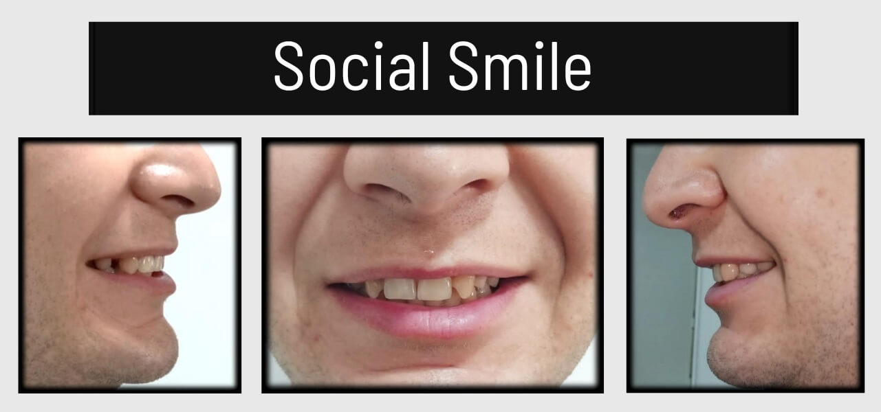 Smile Designing | Joshua Anthony – Richardson's Plastic Surgery Hospitals