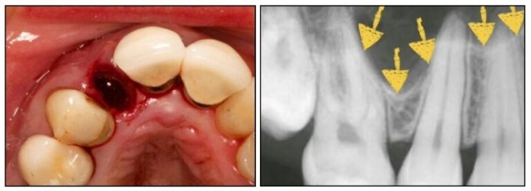 Dental Extraction | A Comprehensive Guide to Procedure, Reasons, and ...