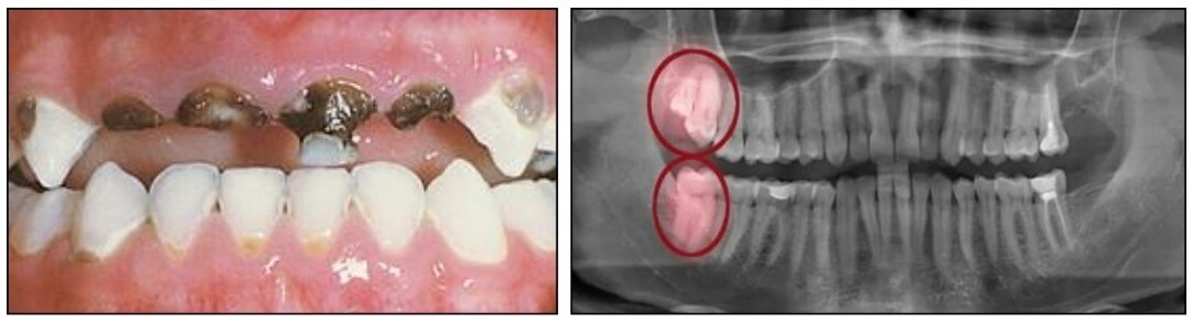 Dental Extraction | A Comprehensive Guide to Procedure, Reasons, and ...
