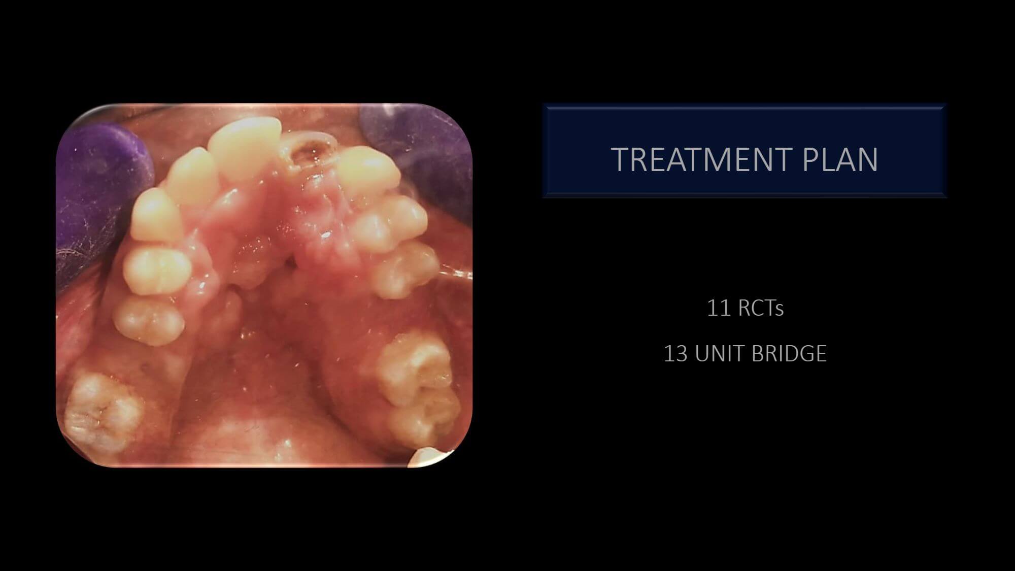 Prosthetic Rehabilitation Post Anterior Maxillary Distraction ...