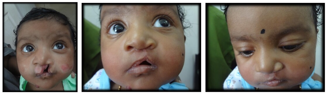 Orthodontics In A Cleft Patient Healthy Life Arch Expansion And ...