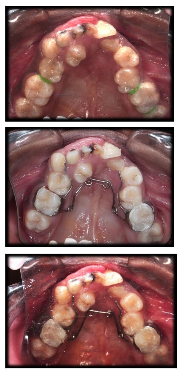 Orthodontics In A Cleft Patient Healthy Life Arch Expansion And ...