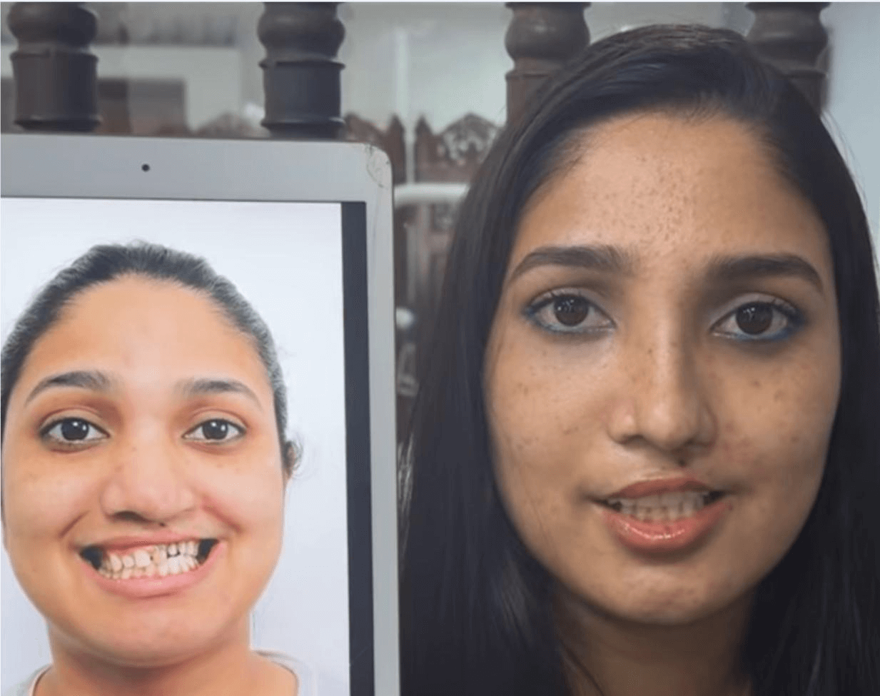 The Surgical Journey Of Cleft Nasal Deformity Correction – Richardson's ...