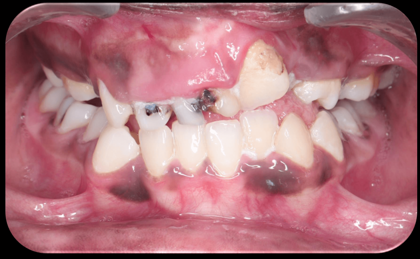 Orthodontics In A Cleft Patient Healthy Life Arch Expansion And ...