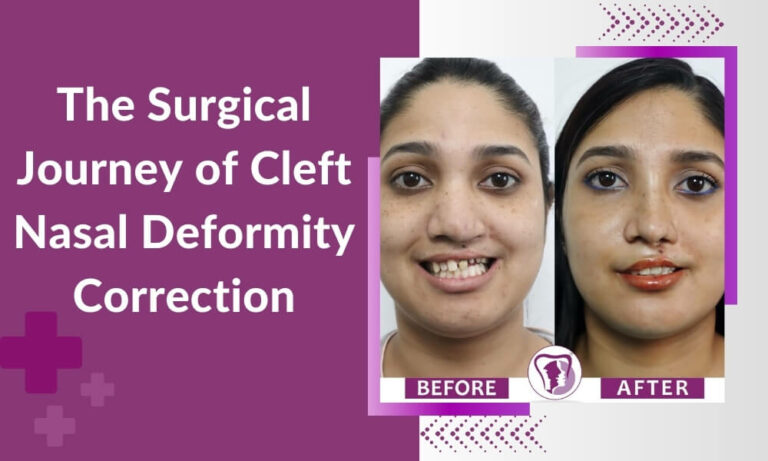 Nose Bridge Surgery for A Depressed Nasal Bridge – Richardson's Plastic ...