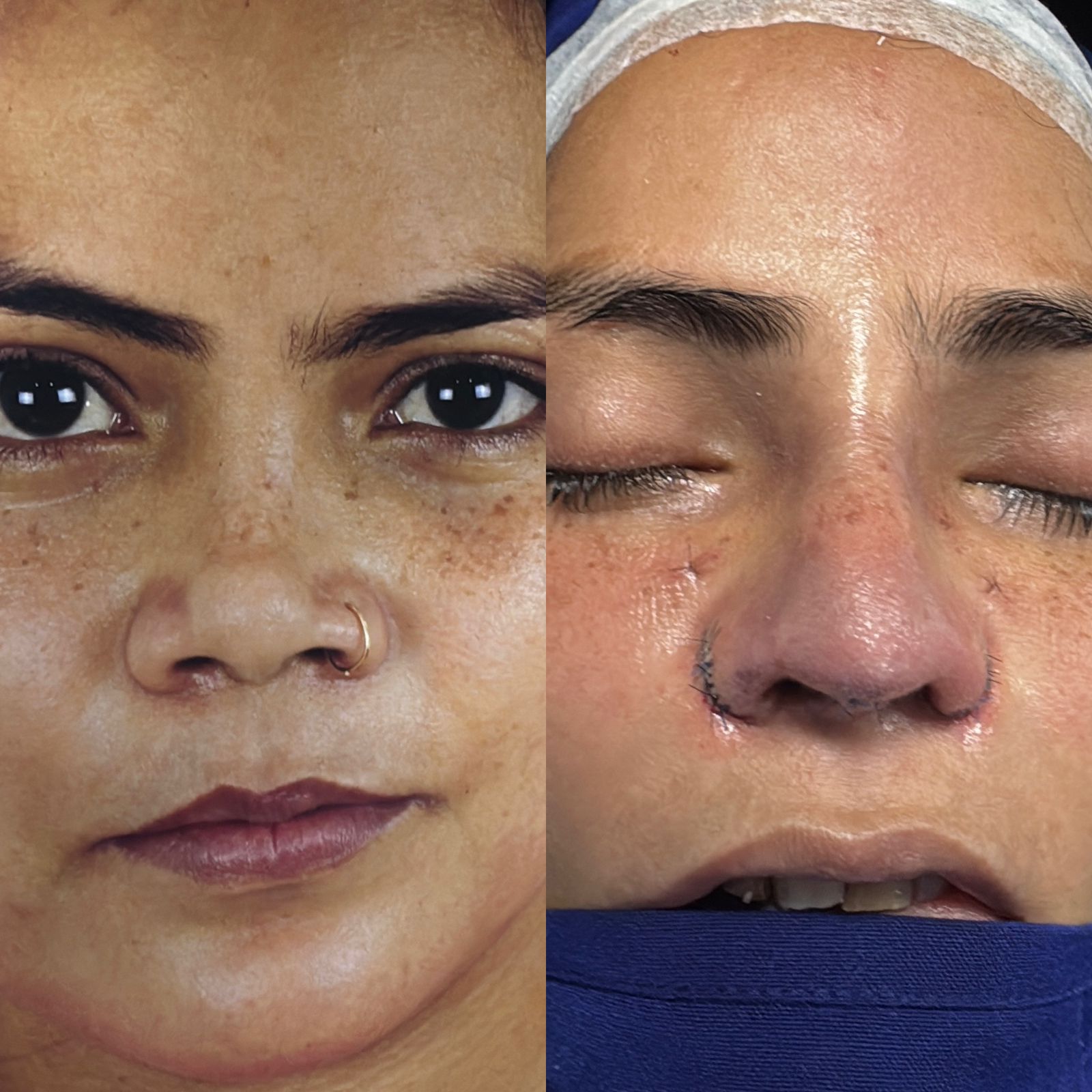 Cleft Rhinoplasty – Richardson's Plastic Surgery Hospitals